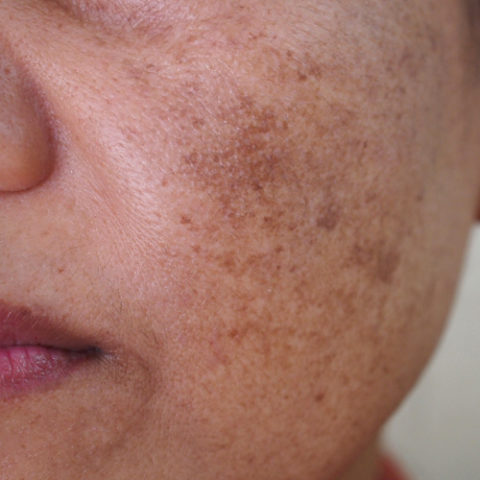 Stem Cell Facial - Complexion Med Spa